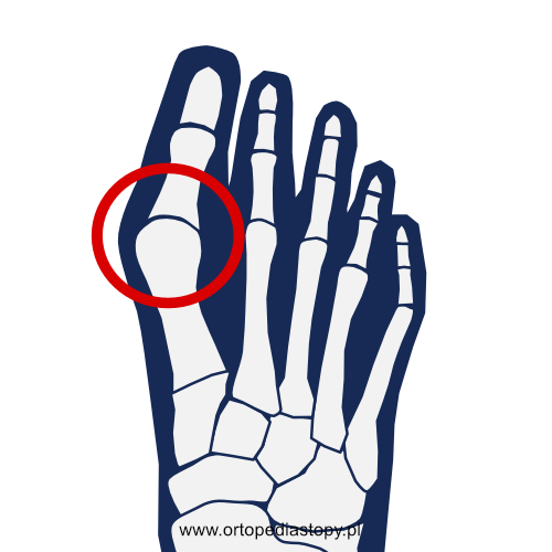 Osteotomia Akina w korekcji palucha koślawego - Ortopedia Online