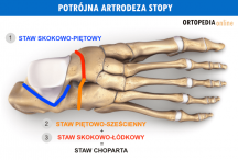 Potrójna artrodeza stopy - Ortopedia Online