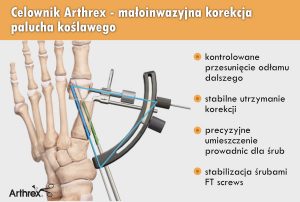 Arthrex MIS bunionectomy system - celownik ułatwiający wykonanie ...
