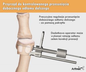 Arthrex MIS bunionectomy system - celownik ułatwiający wykonanie ...